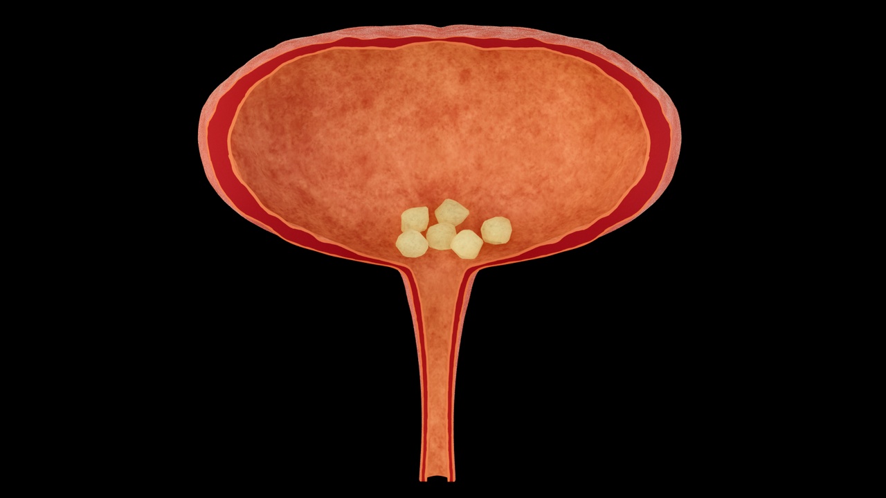 Bladder stones, cystitis, urinary system diseases | Fab