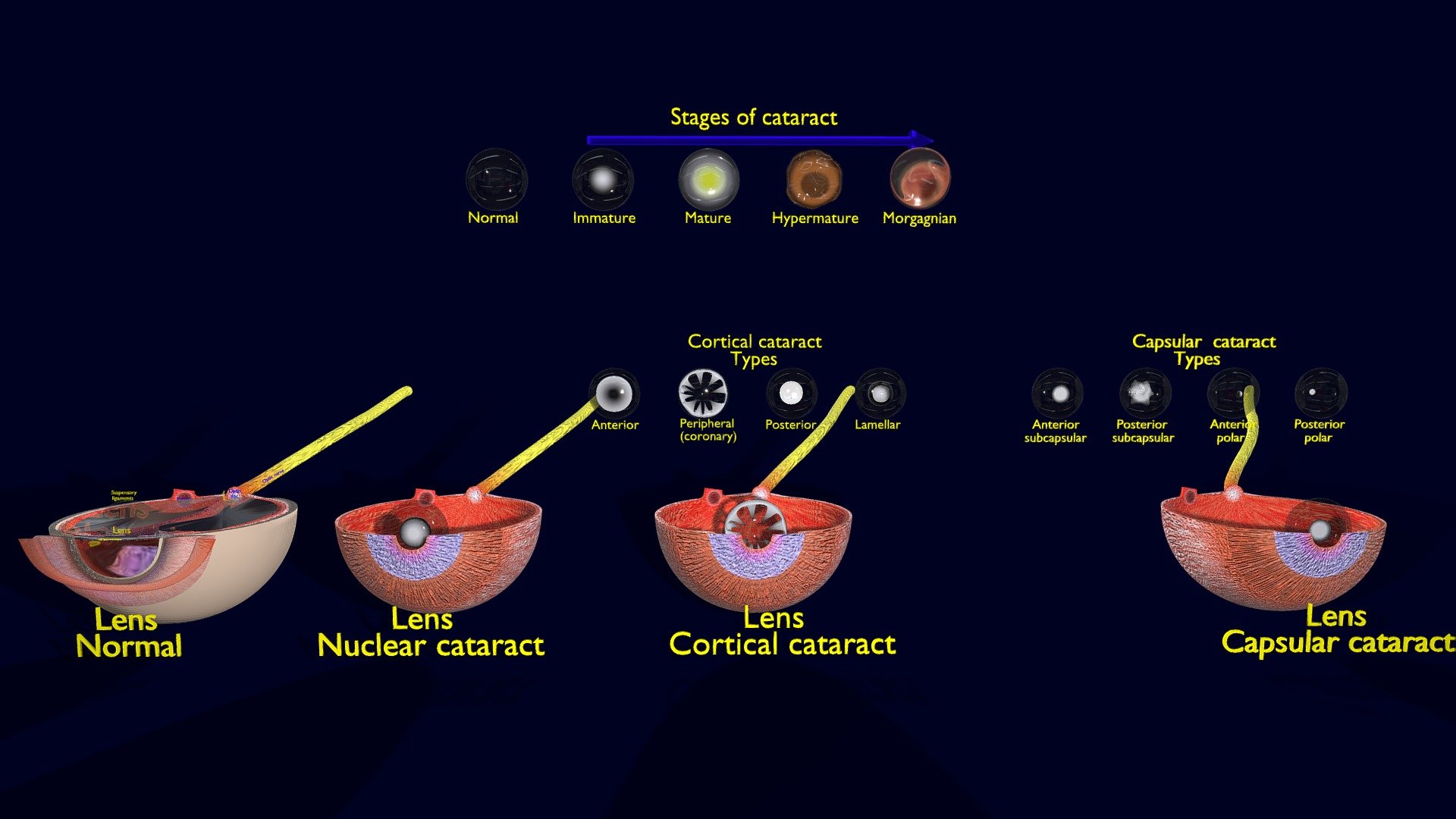 Coronary Cataract