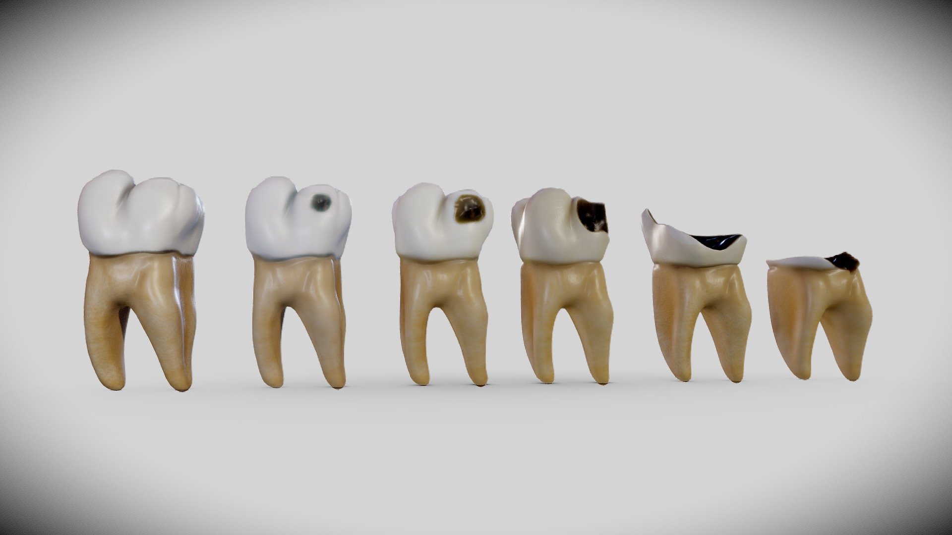 Carie Dentaria Molar Genetic Determinants Of Risk And Resistance To