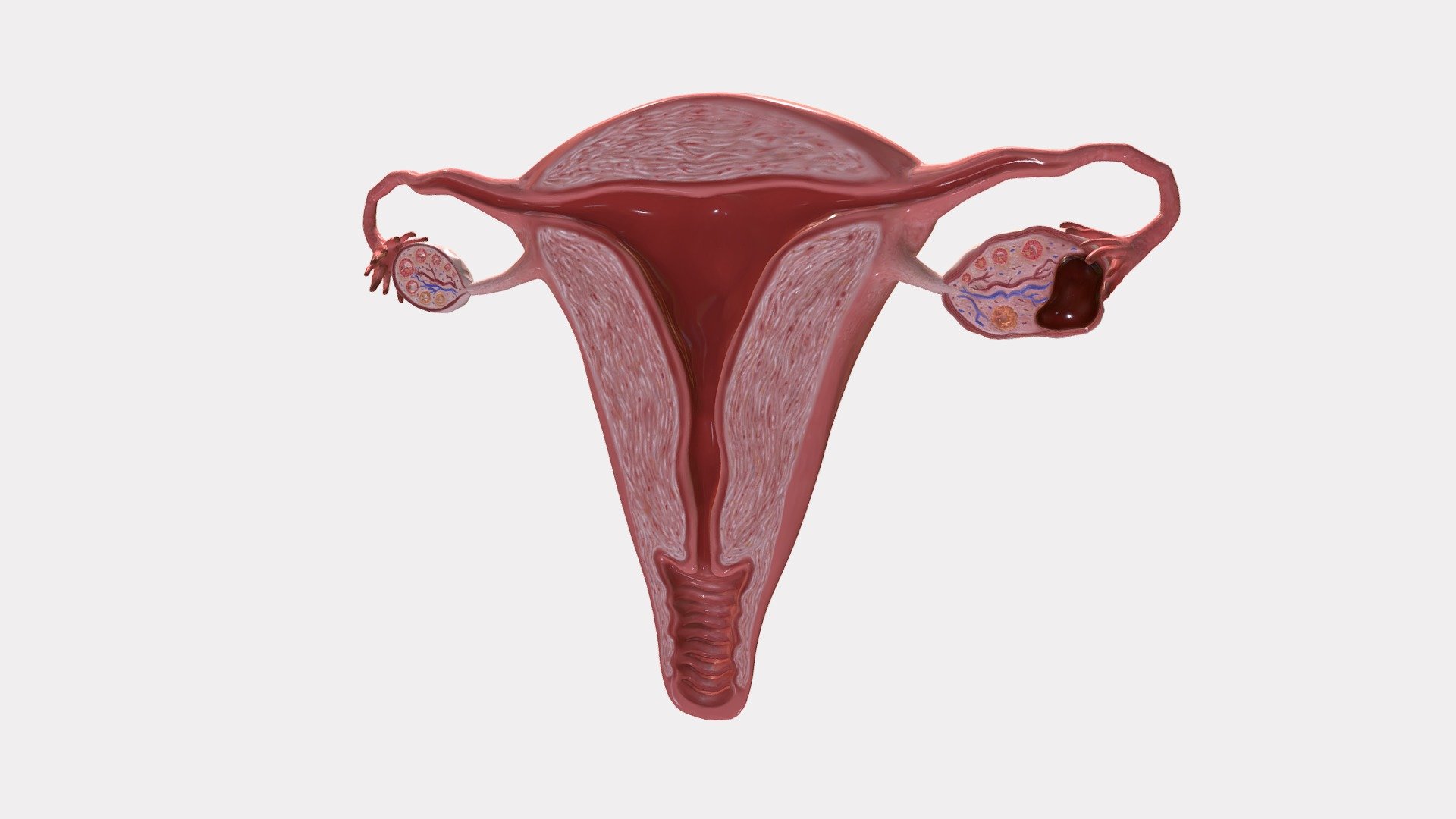 Uterus Cross-Section with Endometrioma | Fab